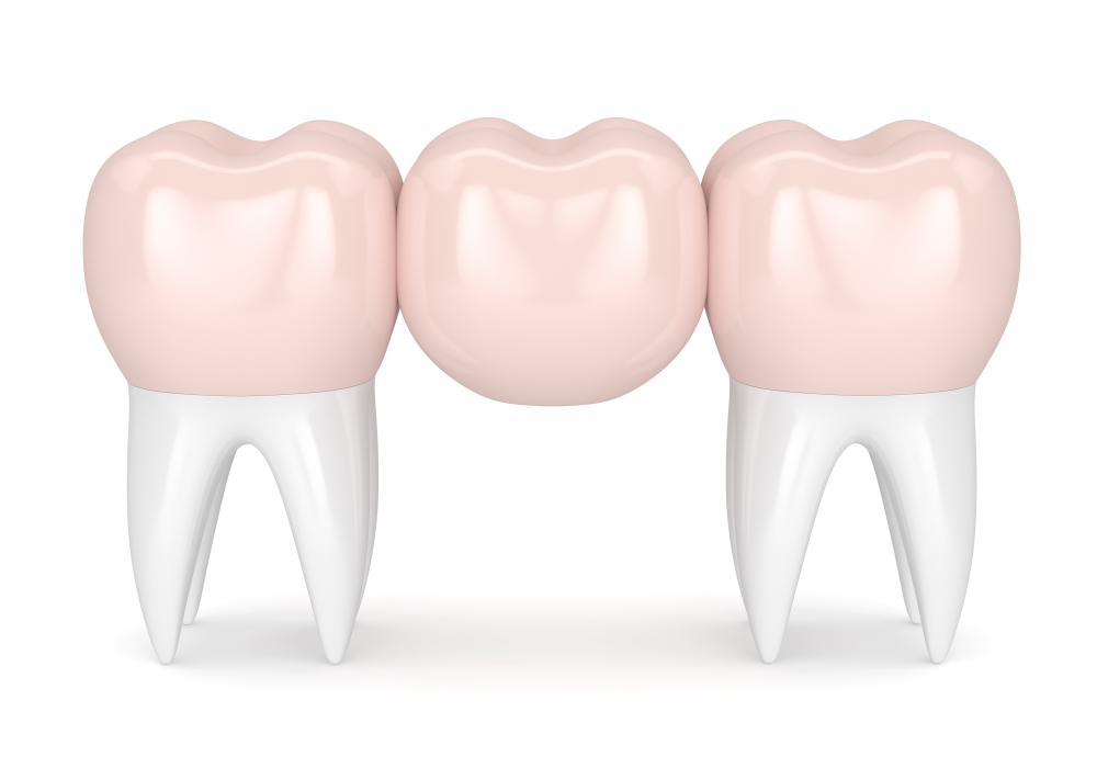 Fixed Prosthodontics - Papakostas Dental Services