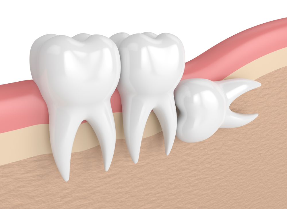 Wisdom Teeth - Papakostas Dental Services